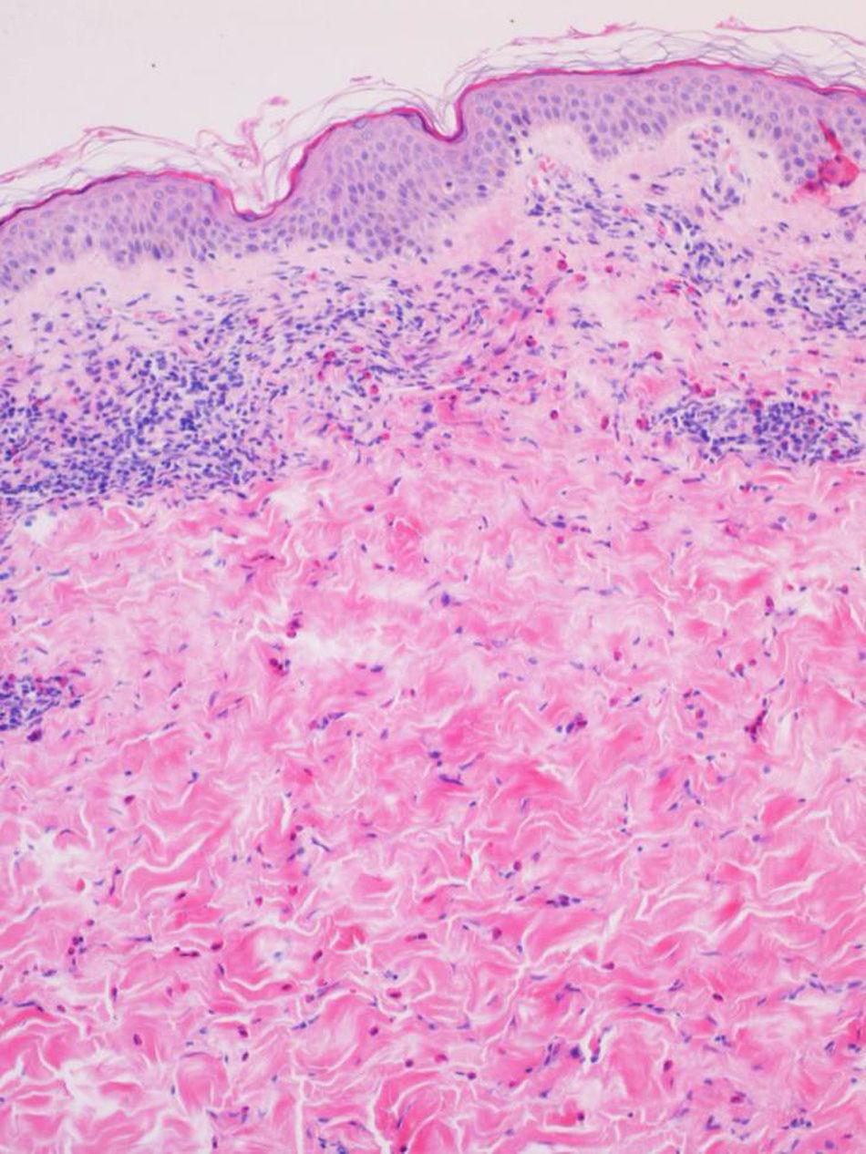 Autochthonous Cutaneous Larva Migrans Infection in Guipúzcoa | Actas ...
