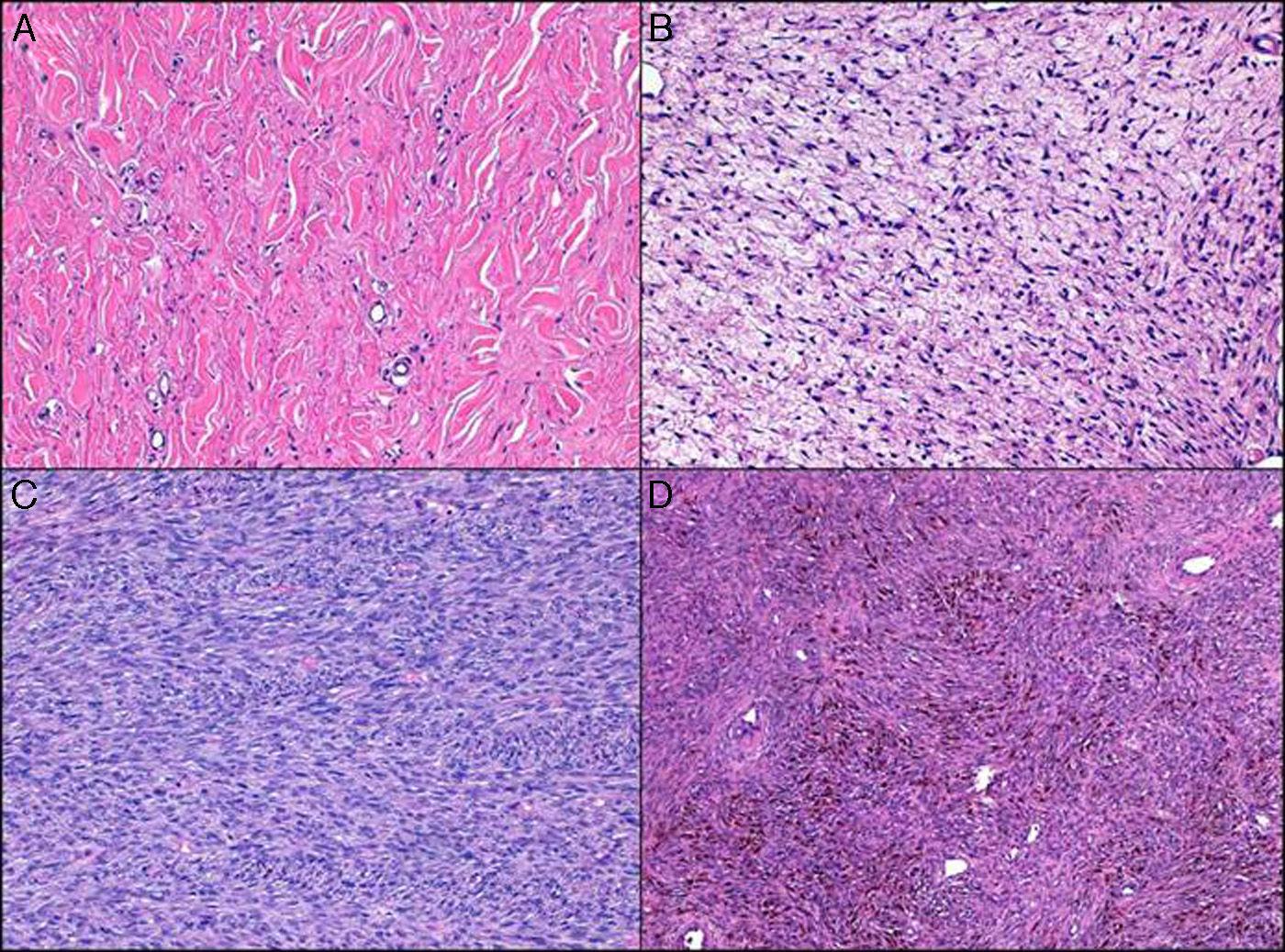 Dermatofibrosarcoma Protuberans Histology