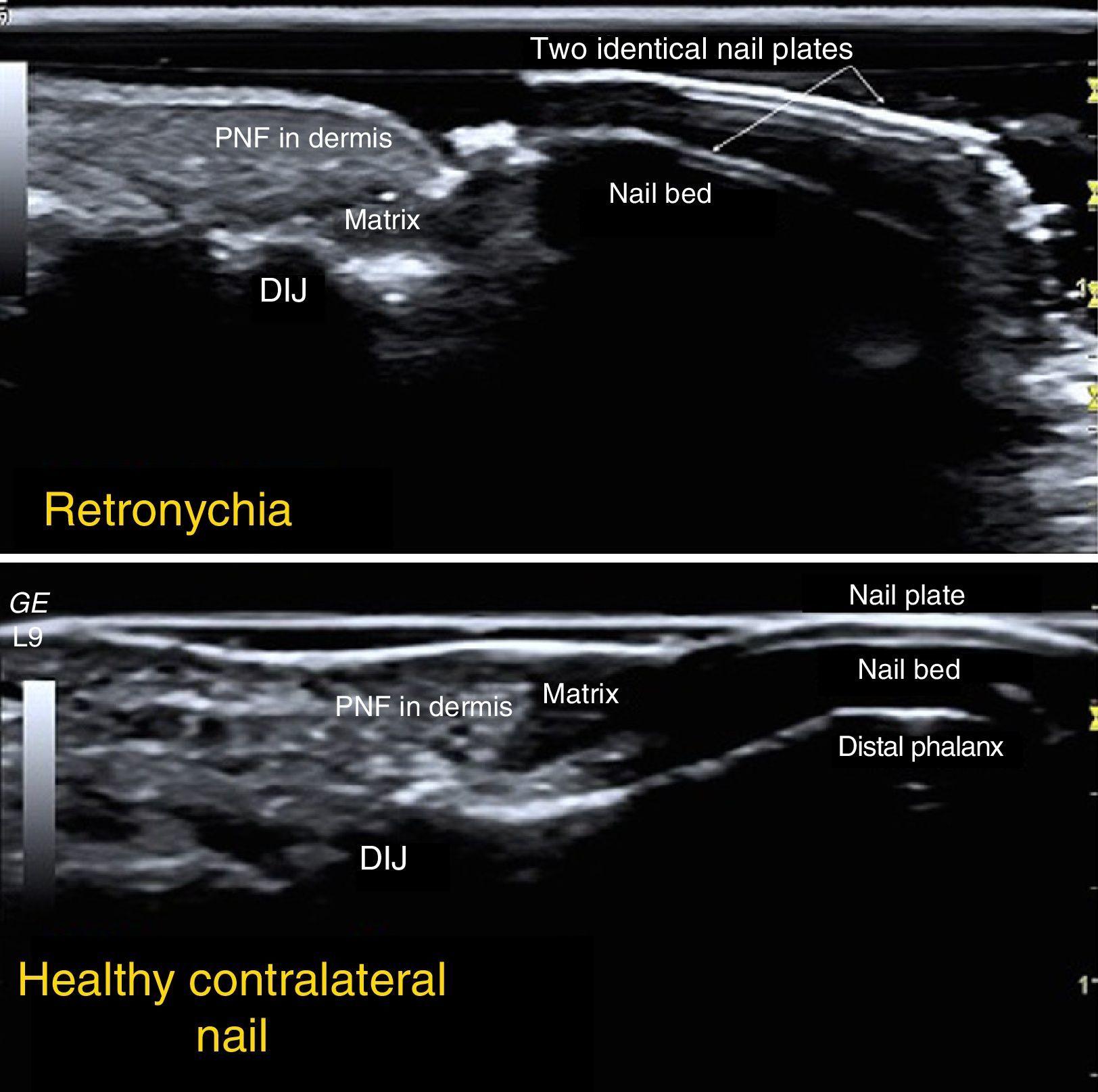 Retronychia: A Case Report Including Ultrasound Imaging and Surgical ...