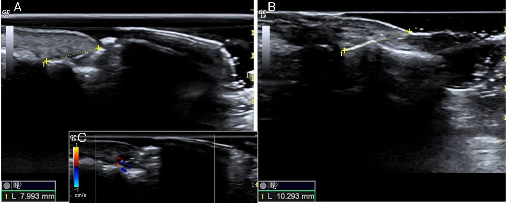 Retronychia: A Case Report Including Ultrasound Imaging and Surgical ...