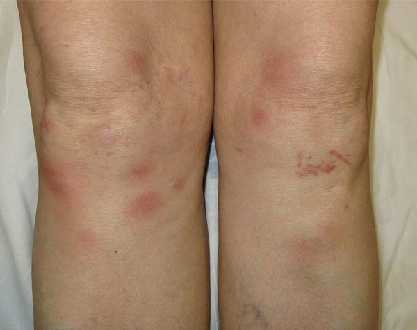 Erythema Nodosum Legs