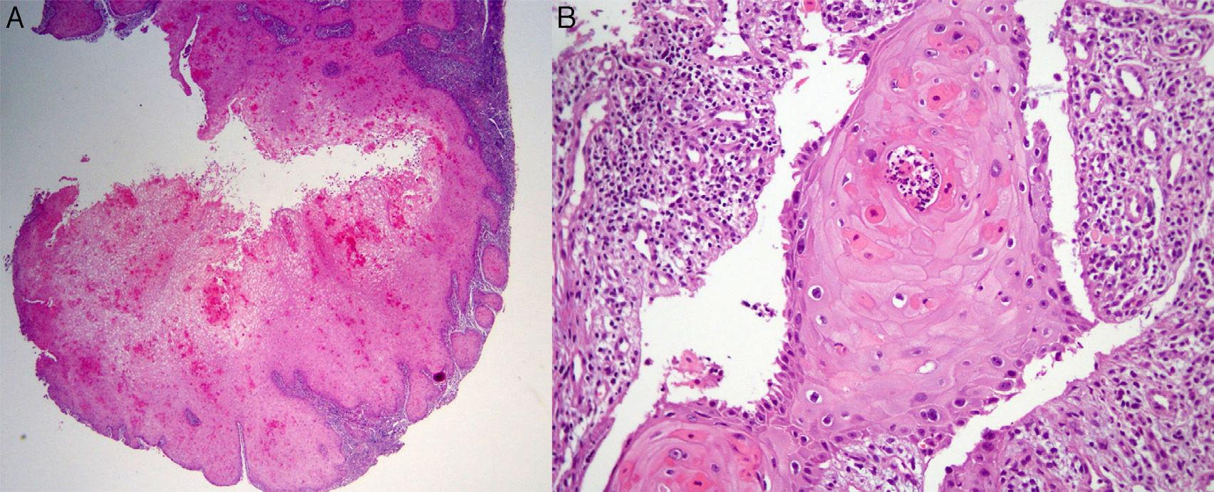 Unusual Ultrasound Appearance of Subungual Keratoacanthoma With ...