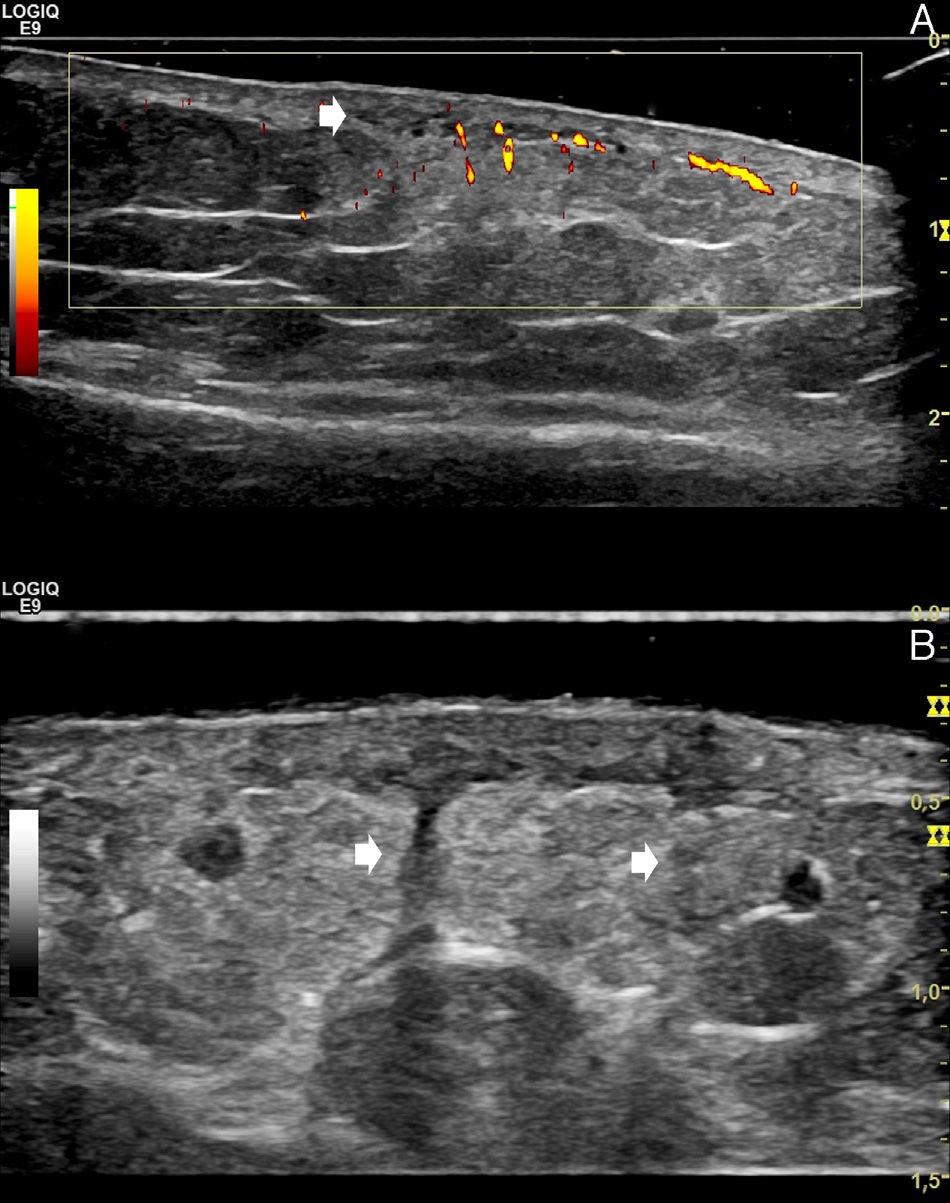 Sarcoidal Necrobiosis Lipoidica in a Nondiabetic Patient: Usefulness of ...