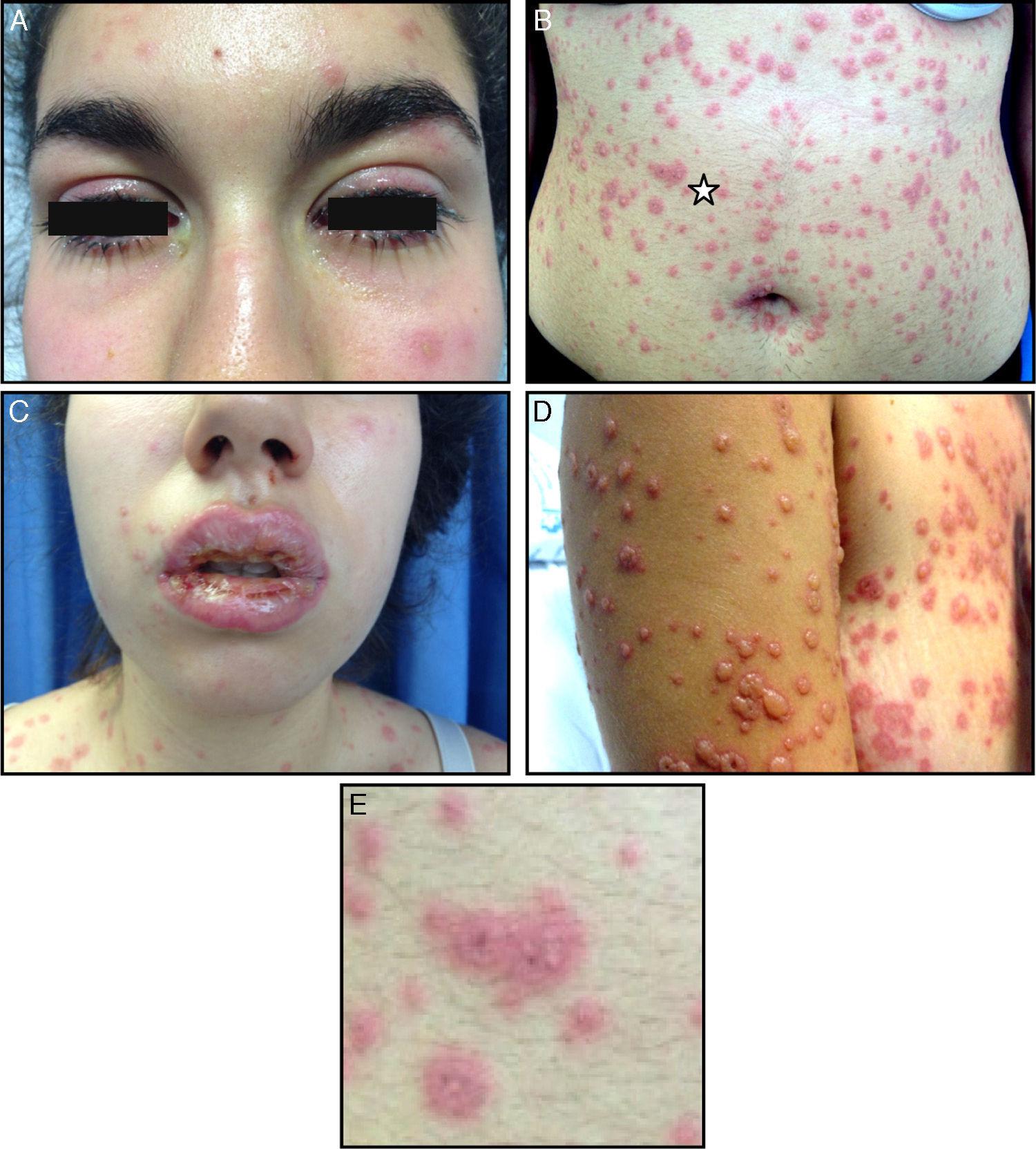 Mycoplasma pneumoniae-Induced Mucocutaneous Rash: A New Syndrome ...