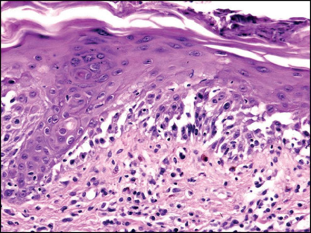 Mycoplasma pneumoniae-Induced Mucocutaneous Rash: A New Syndrome ...