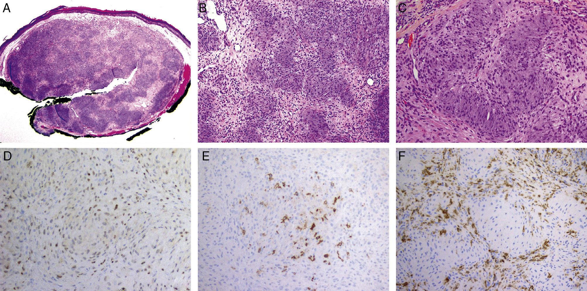 Plexiform Neurofibroma Histology