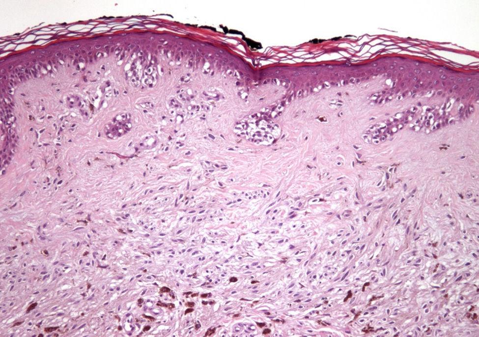 Junctional Nevus Histology