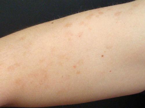 Hyperpigmented Macules on a Young Man's Arms | Actas Dermo-Sifiliográficas