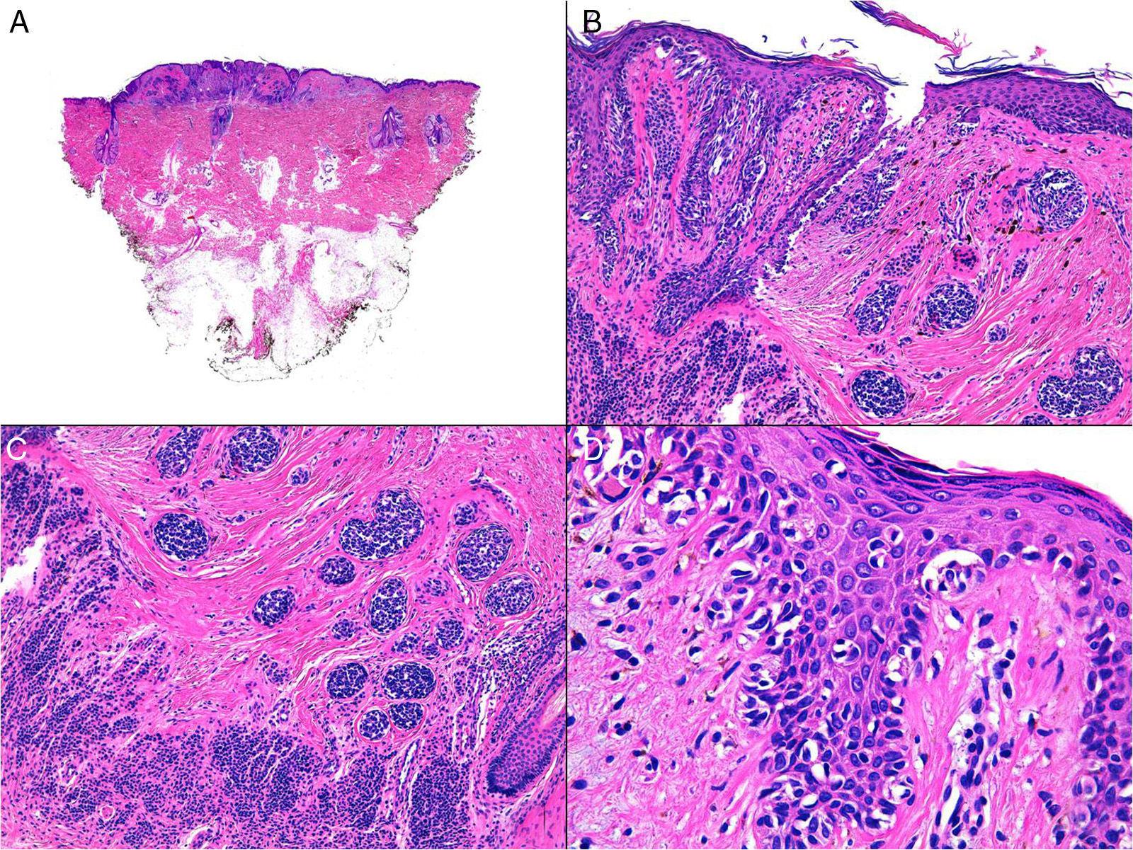 Sclerosing Nevus With Pseudomelanomatous Features: A Case Report ...