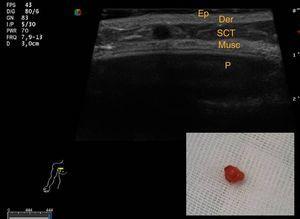 Skin Ultrasound Features of Encapsulated Fat Necrosis | Actas Dermo ...