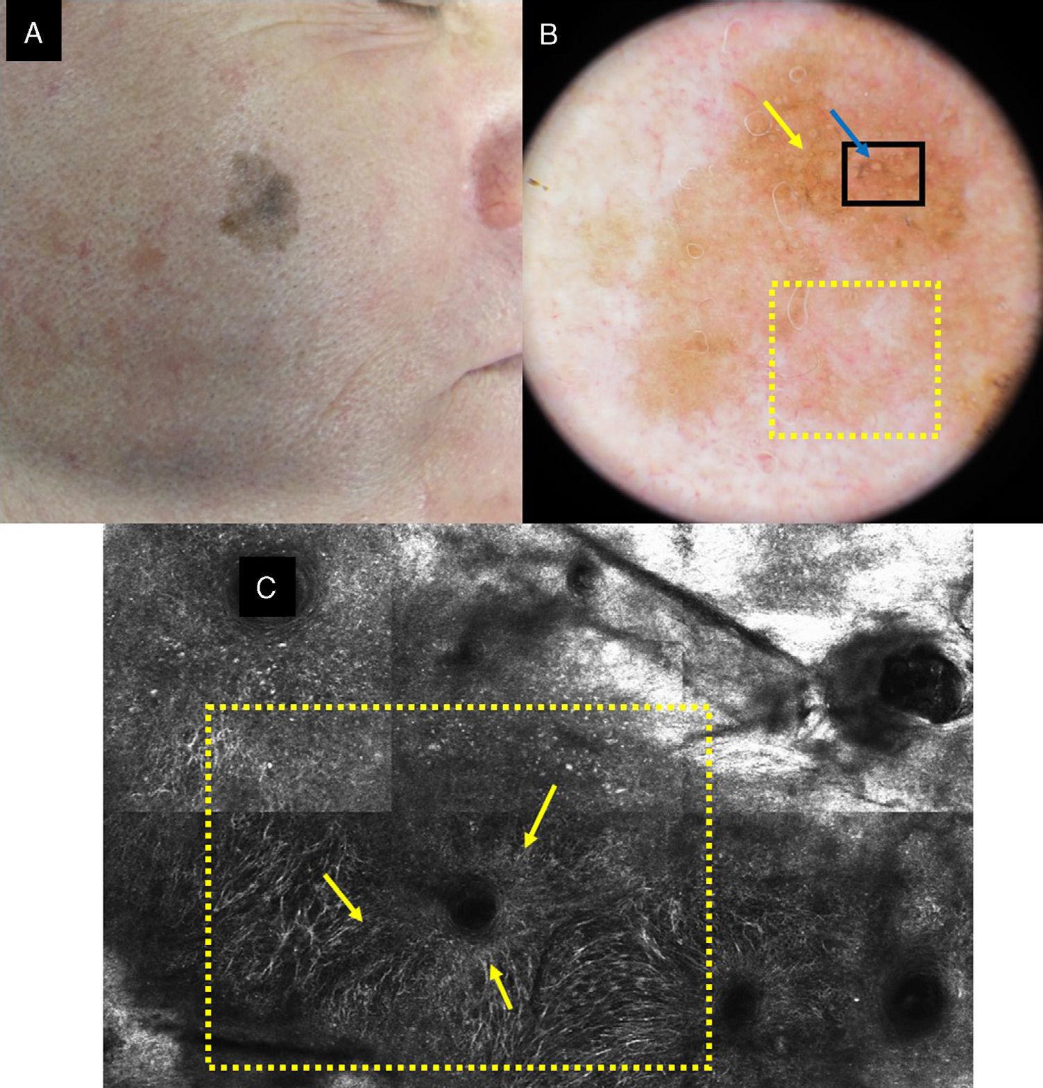 Reflectance Confocal Microscopy in Lentigo Maligna | Actas Dermo ...