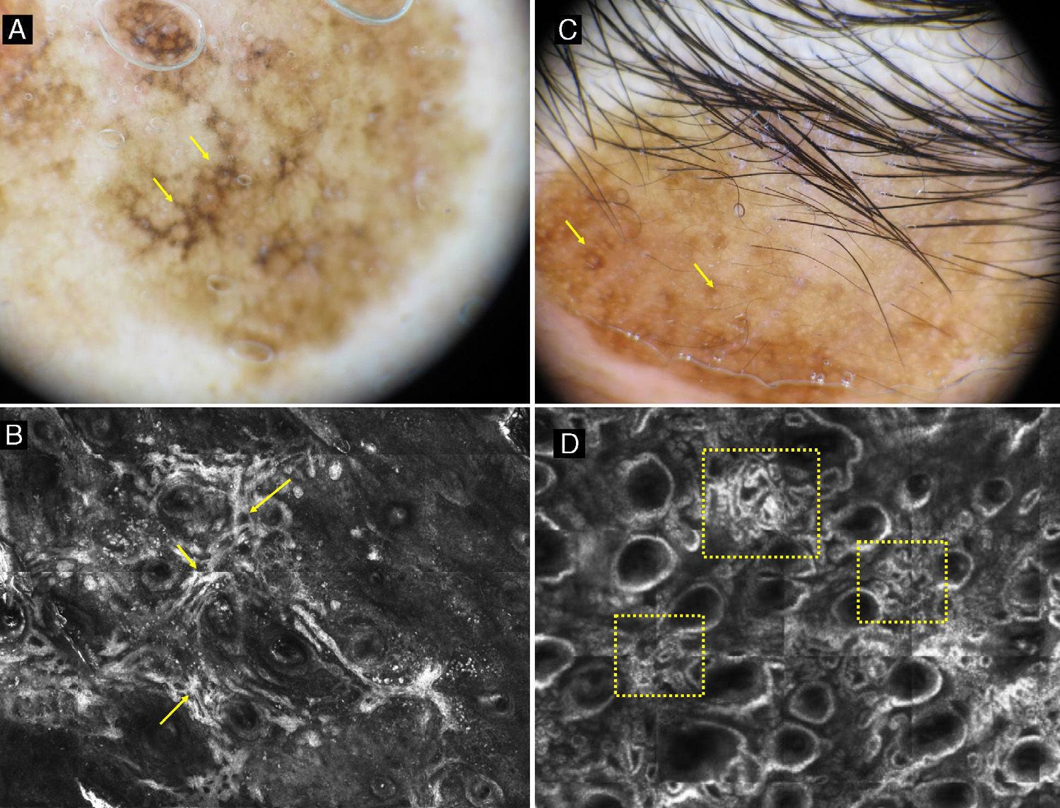 Reflectance Confocal Microscopy in Lentigo Maligna | Actas Dermo ...