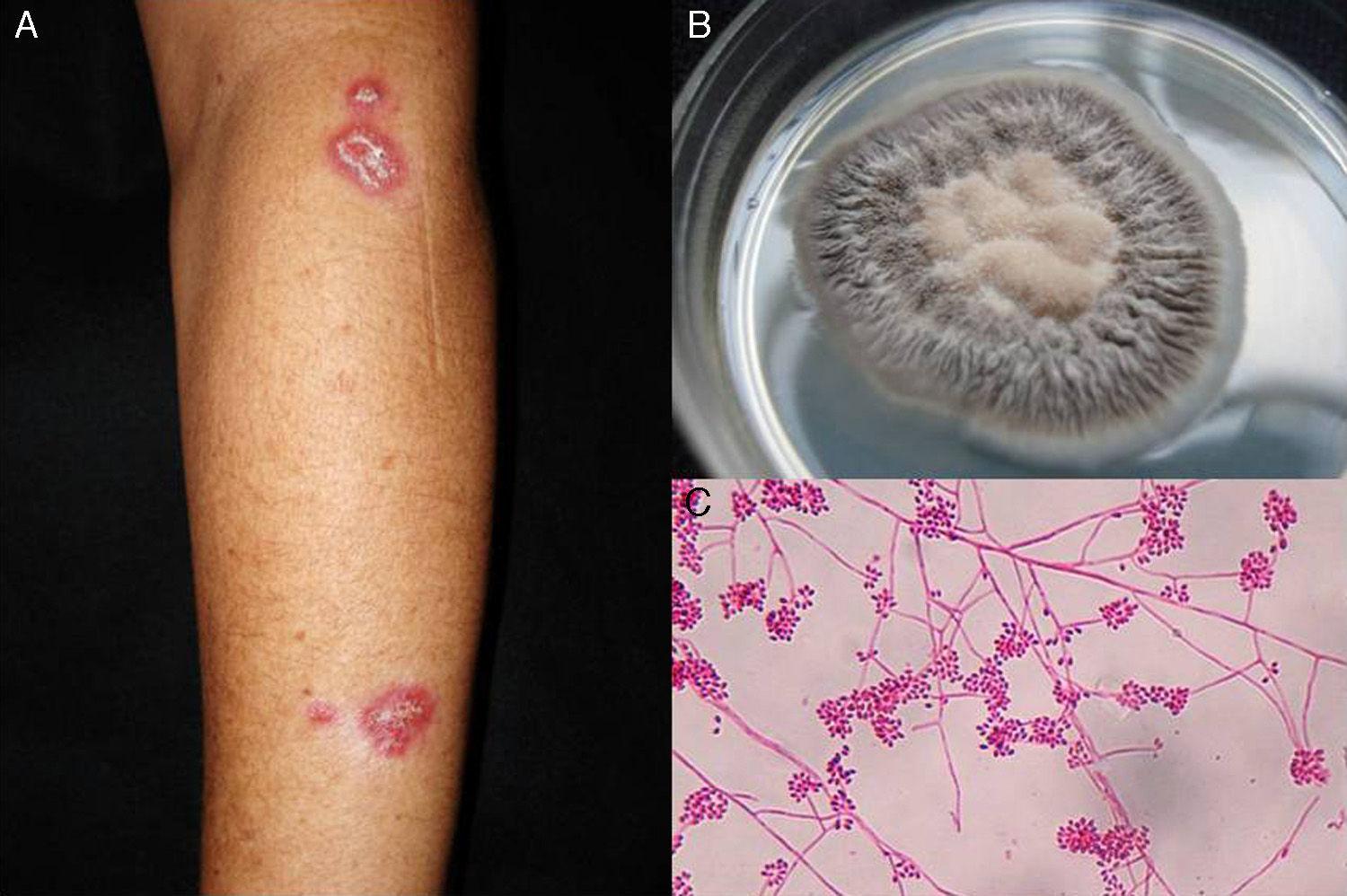 Cutaneous Involvement in the Deep Mycoses: A Literature Review. Part I ...