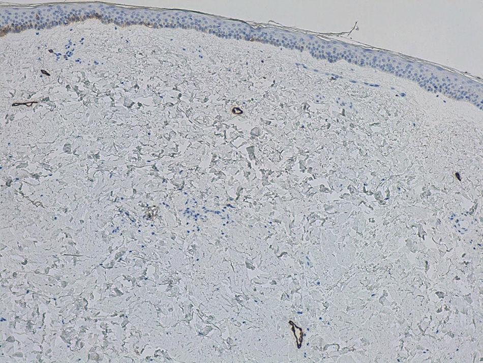 Bullous Morphea: Description of a New Case and Discussion of Etiologic ...