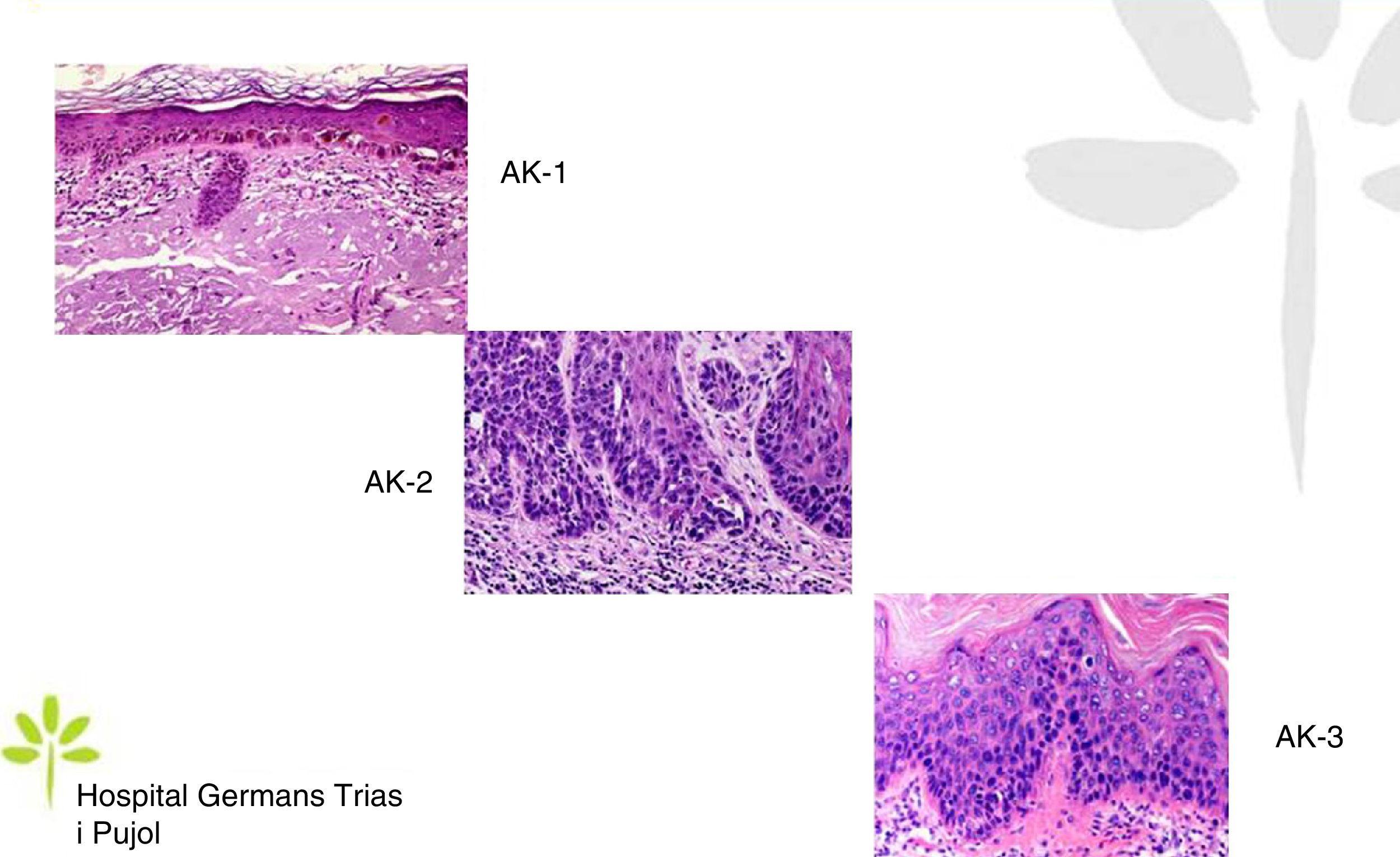 Precancerous Skin Lesions | Actas Dermo-Sifiliográficas