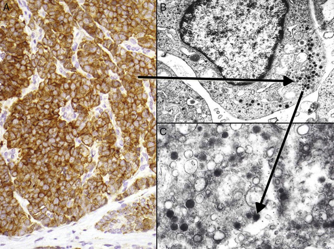 Update on Merkel Cell Carcinoma: Epidemiology, Etiopathogenesis ...