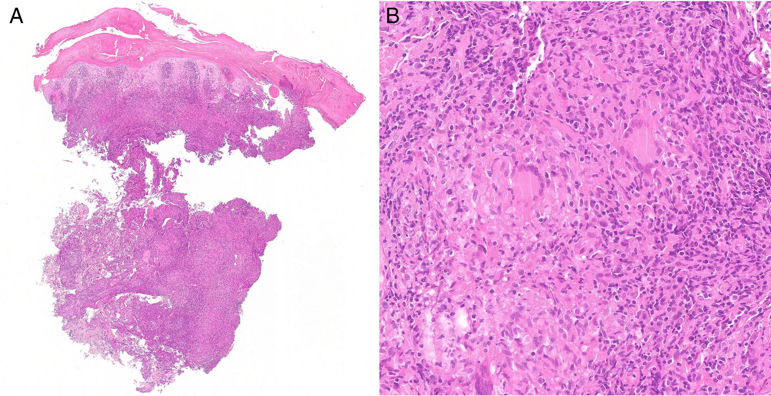Metastatic Crohn Disease | Actas Dermo-Sifiliográficas
