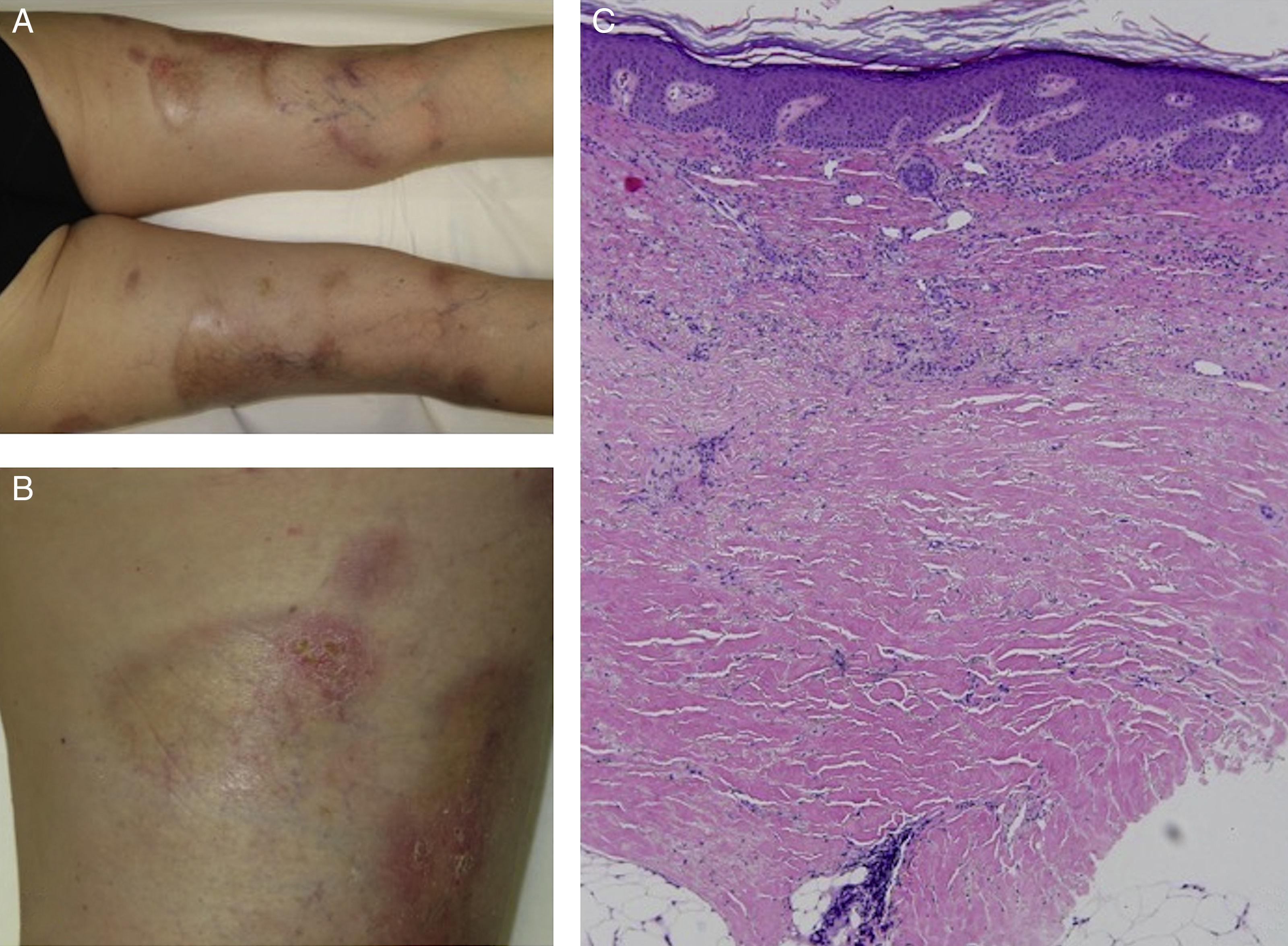 Morphea in a Patient With Psoriasis on Treatment With Ustekinumab ...