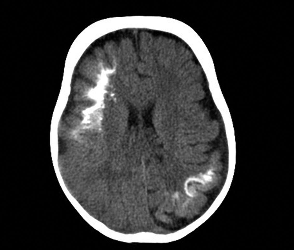 Sturge-Weber Syndrome: A Review | Actas Dermo-Sifiliográficas