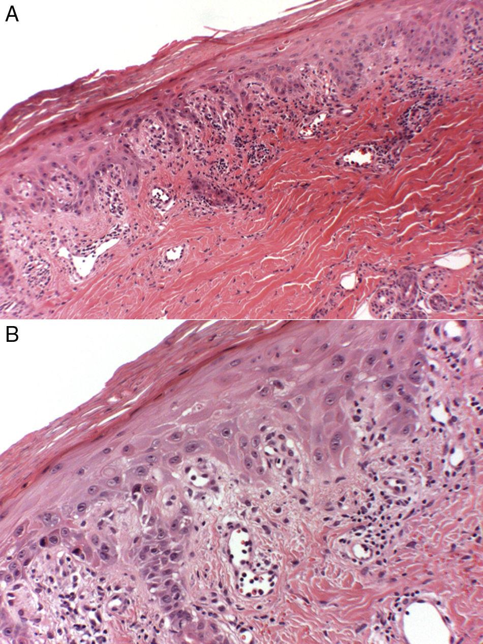 Periarticular Thenar Erythema and Onycholysis Syndrome: A Manifestation ...