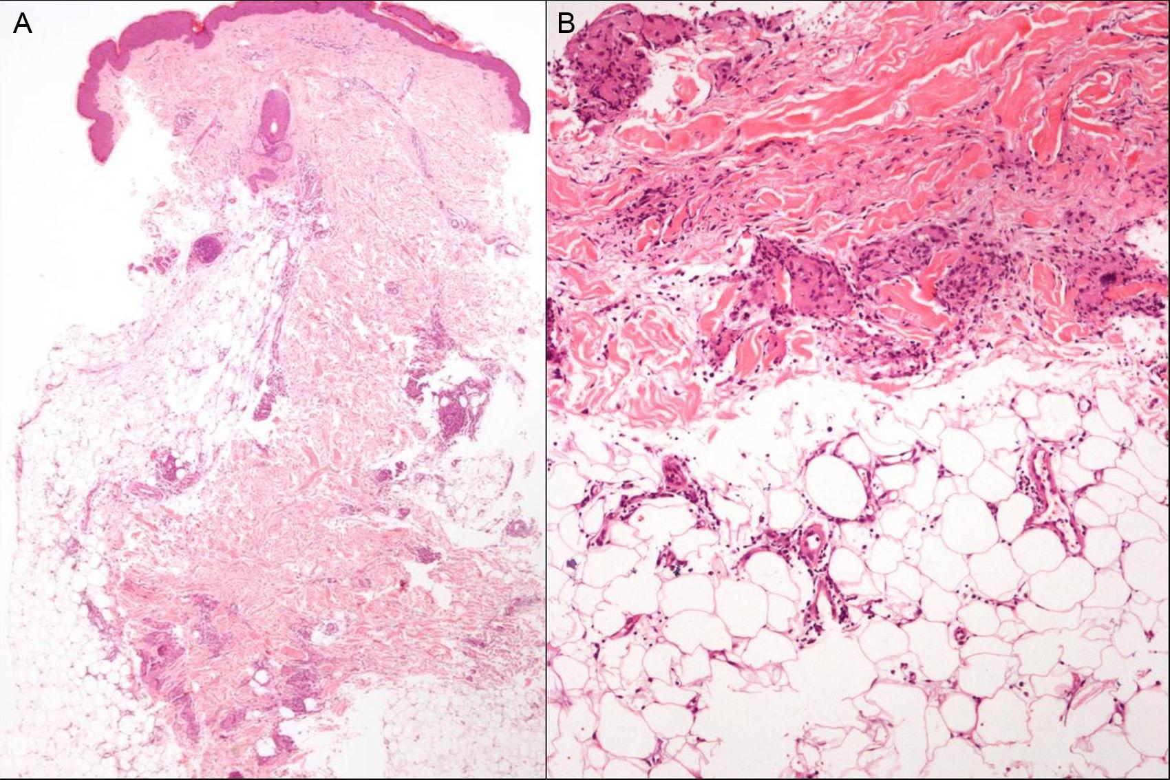 Torus Mandibularis Histology