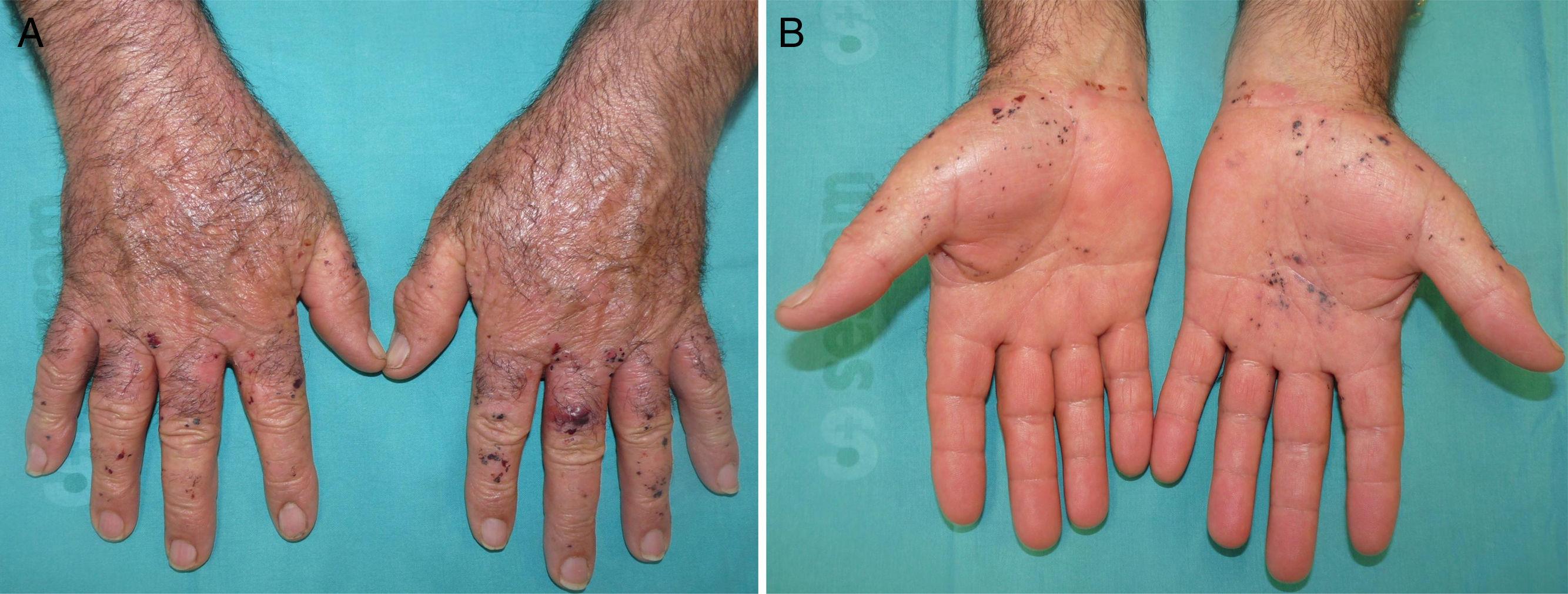 Dermatitis Herpetiformis Palms
