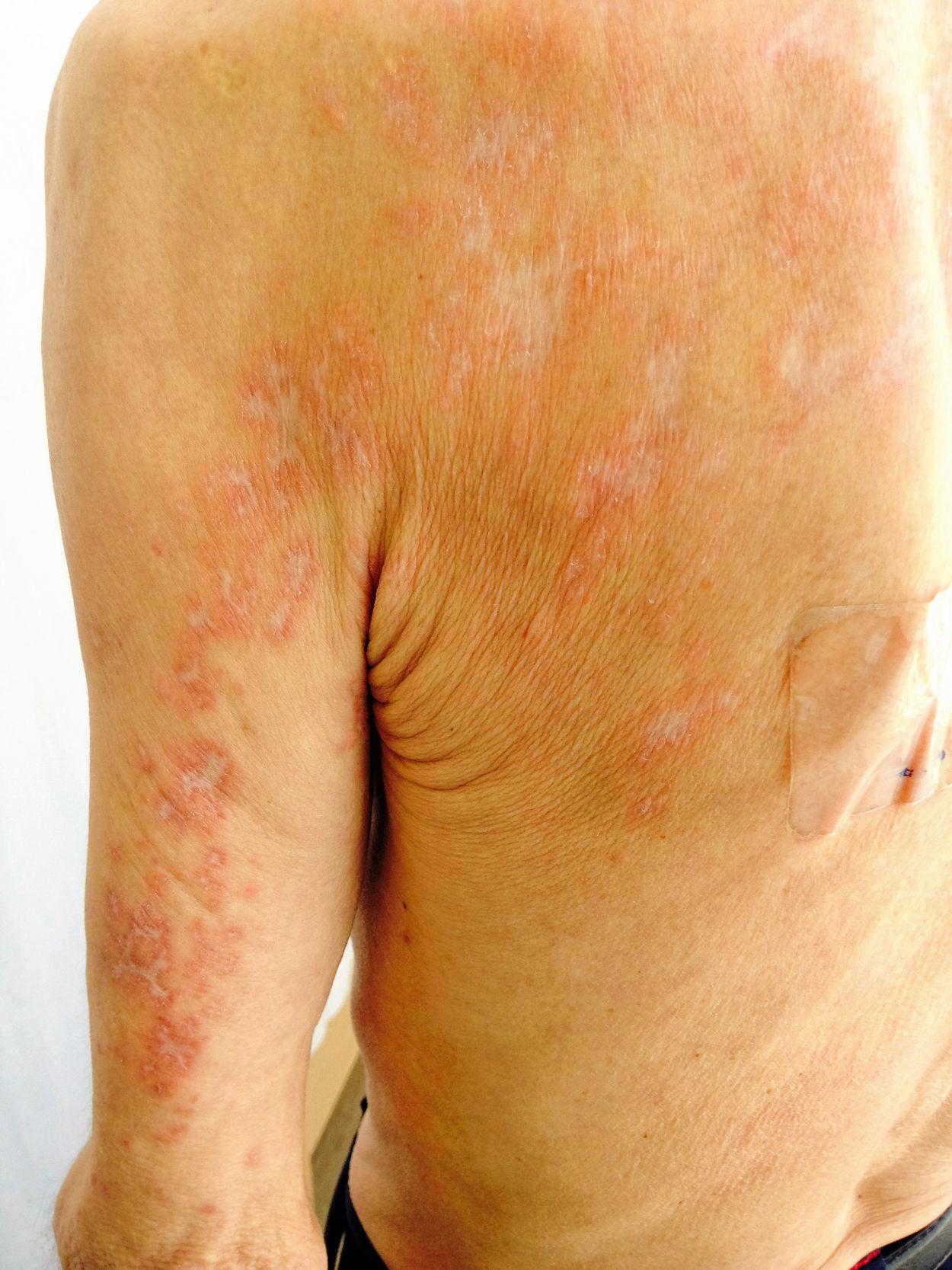 Postherpetic Granulomatous Dermatitis in a Man Treated With Nivolumab ...