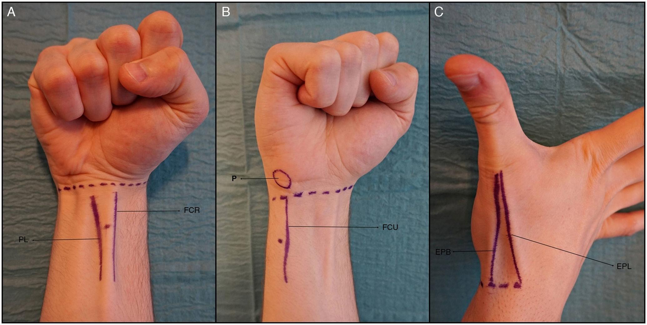 Treatment of Palmar Hyperhidrosis by Peripheral Nerve Block at the ...
