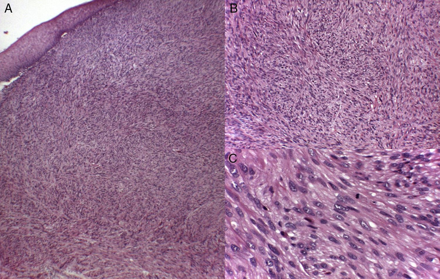 Clinical and Histopathologic Findings of Cutaneous Leiomyosarcoma ...