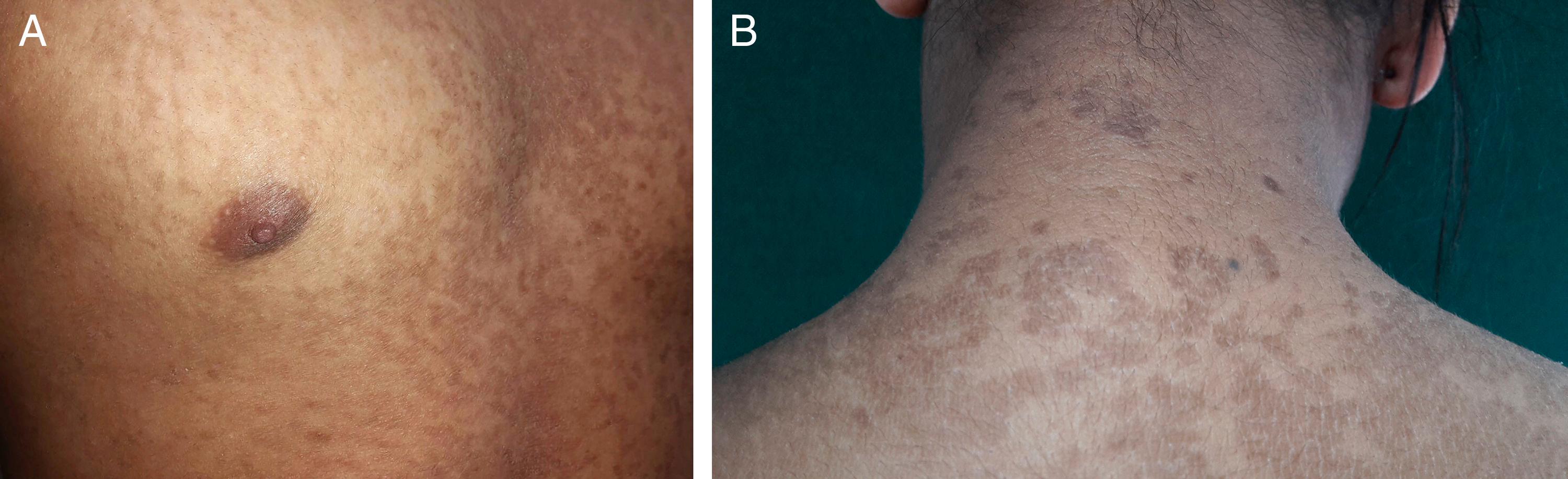 Confluent And Reticulated Papillomatosis