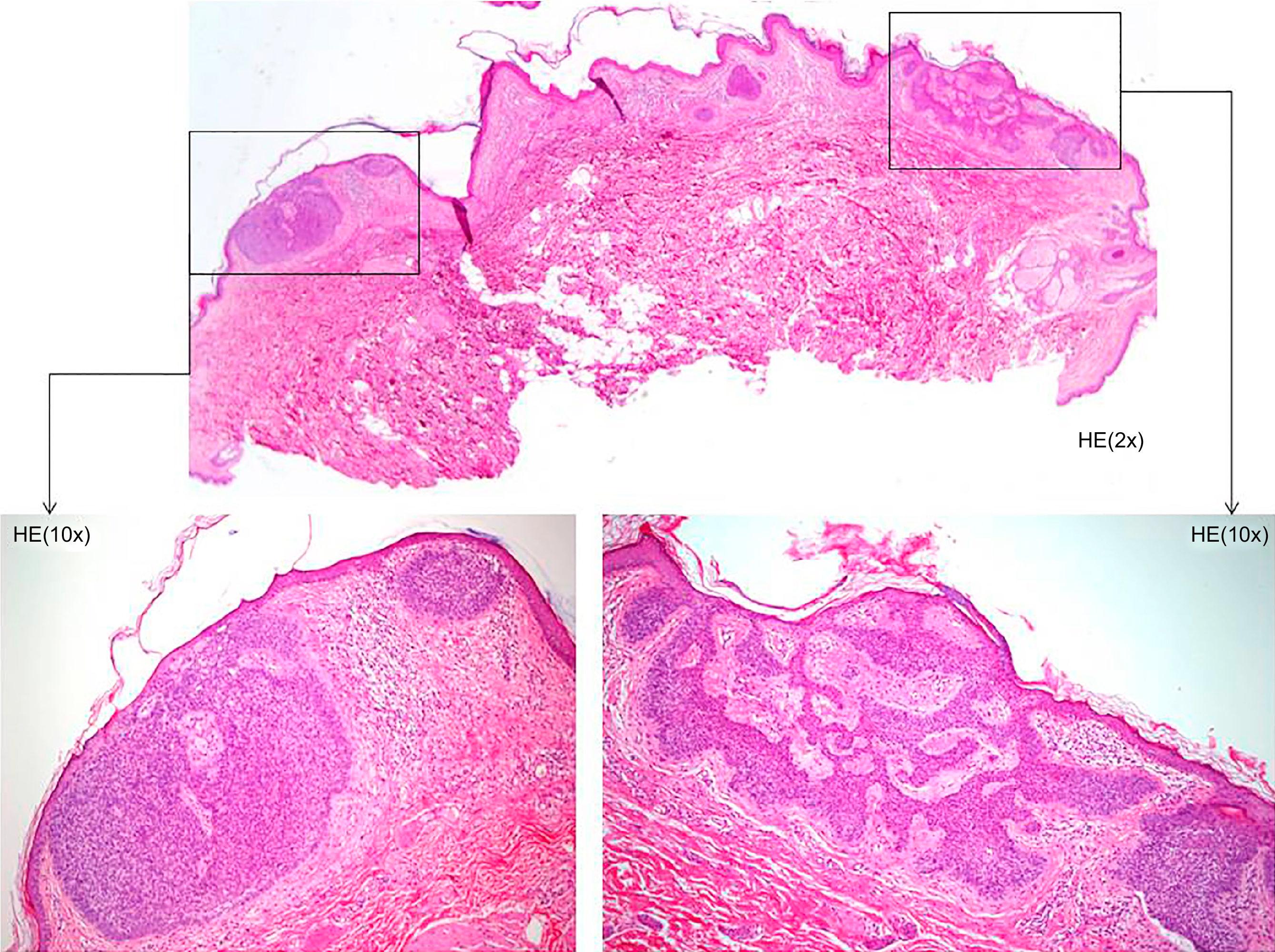 A 65-Year-Old Woman With Multiple Papules in a Unilateral Segmental ...