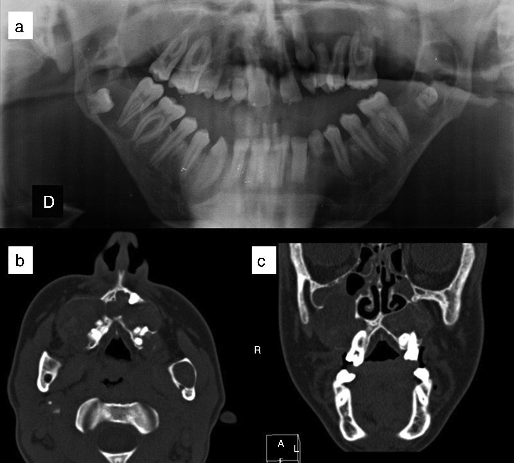 Gorlin Syndrome | Actas Dermo-Sifiliográficas