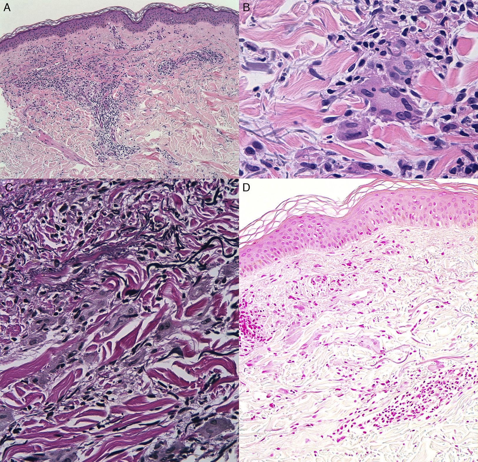Bilateral Annular Plaques on the Hands and Forearms | Actas Dermo ...