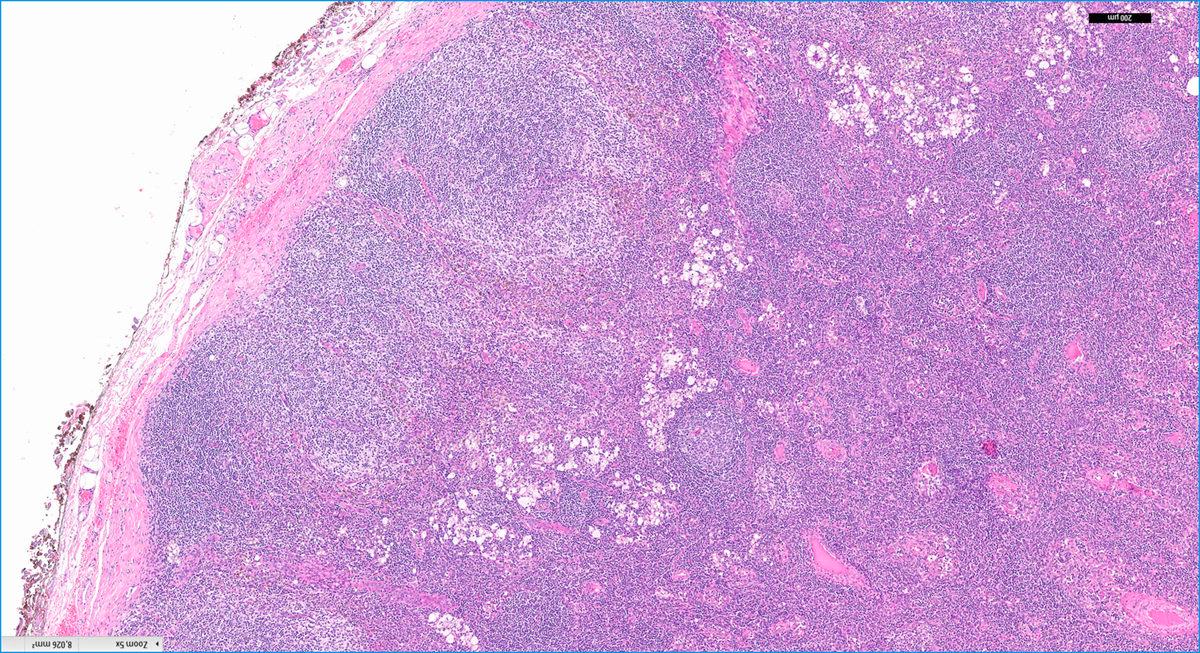 Dermatopathic Lymphadenopathy: Is Our Diagnostic Approach Correct ...