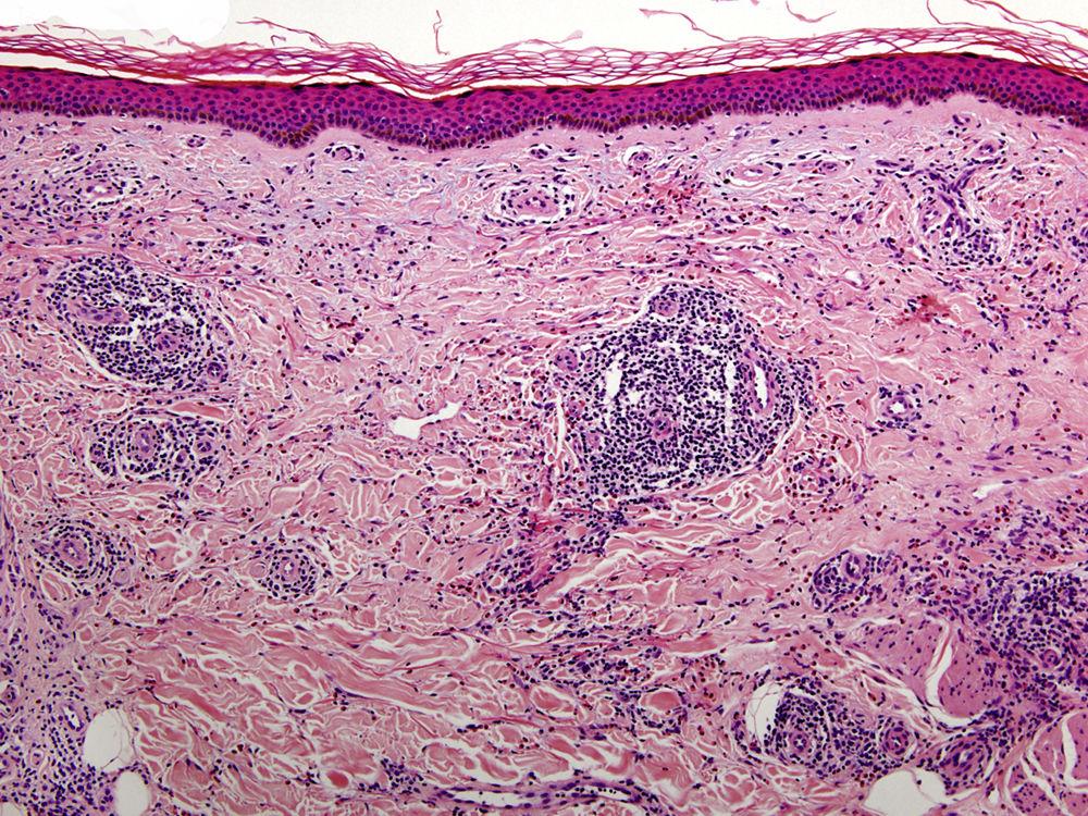 Annular and Polycyclic Lesions on the Lower Limbs | Actas Dermo ...