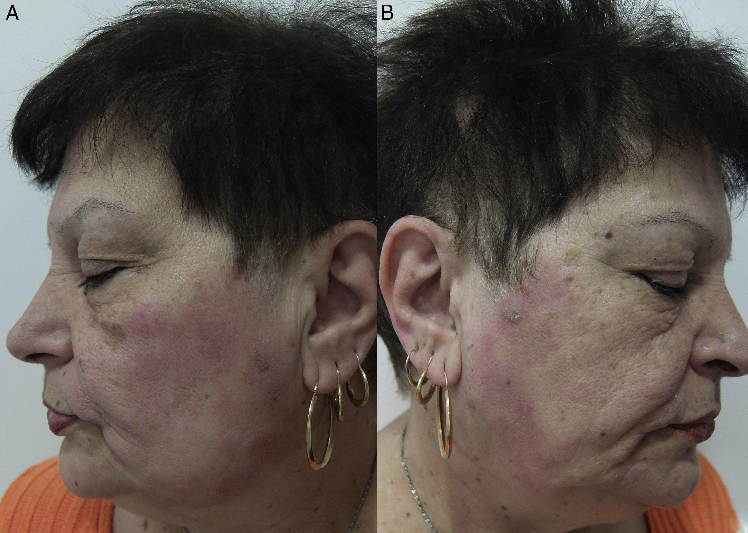 Allergic Contact Dermatitis Face