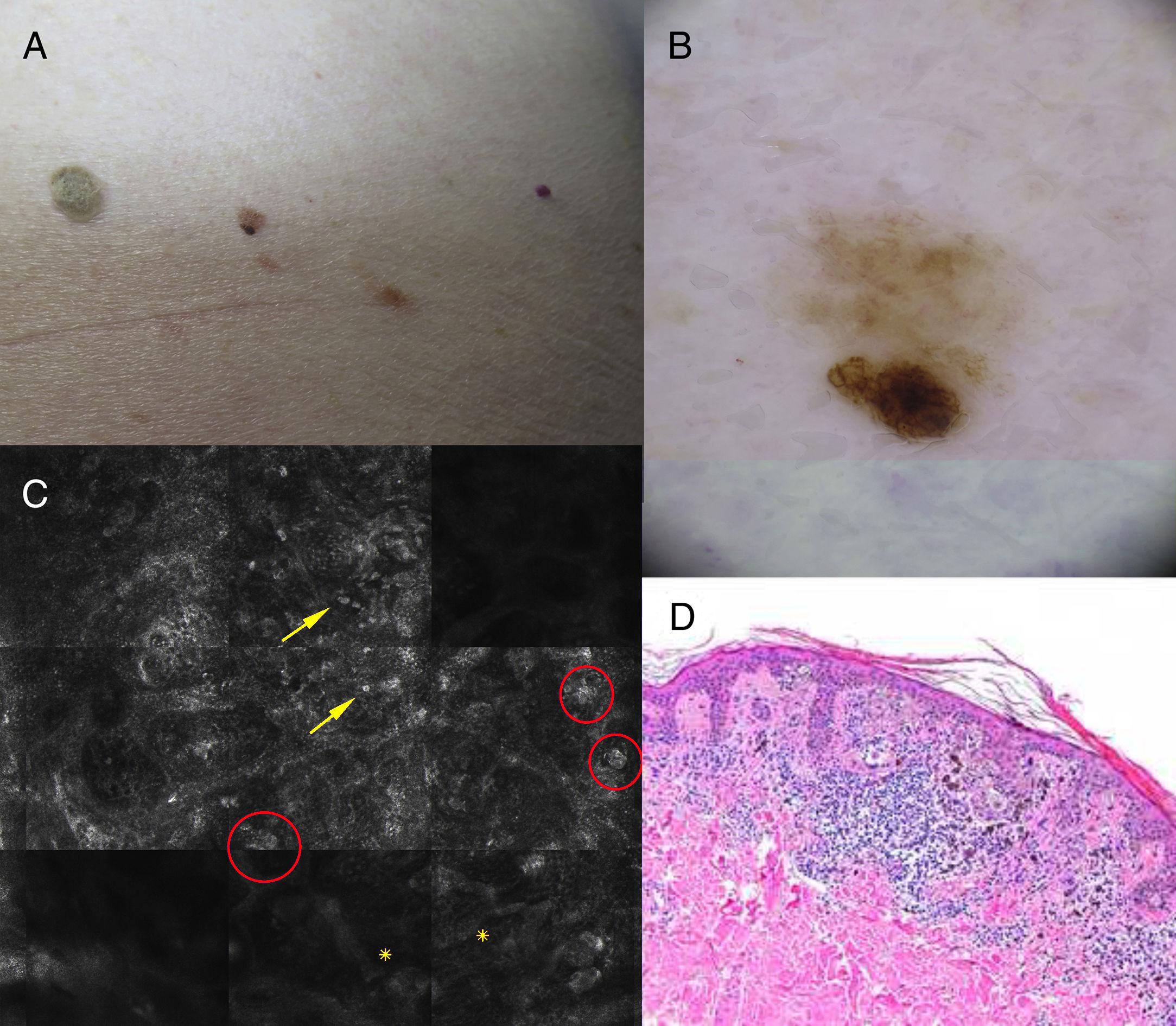 Reflectance Confocal Microscopy: A Promising Tool to Identify ...