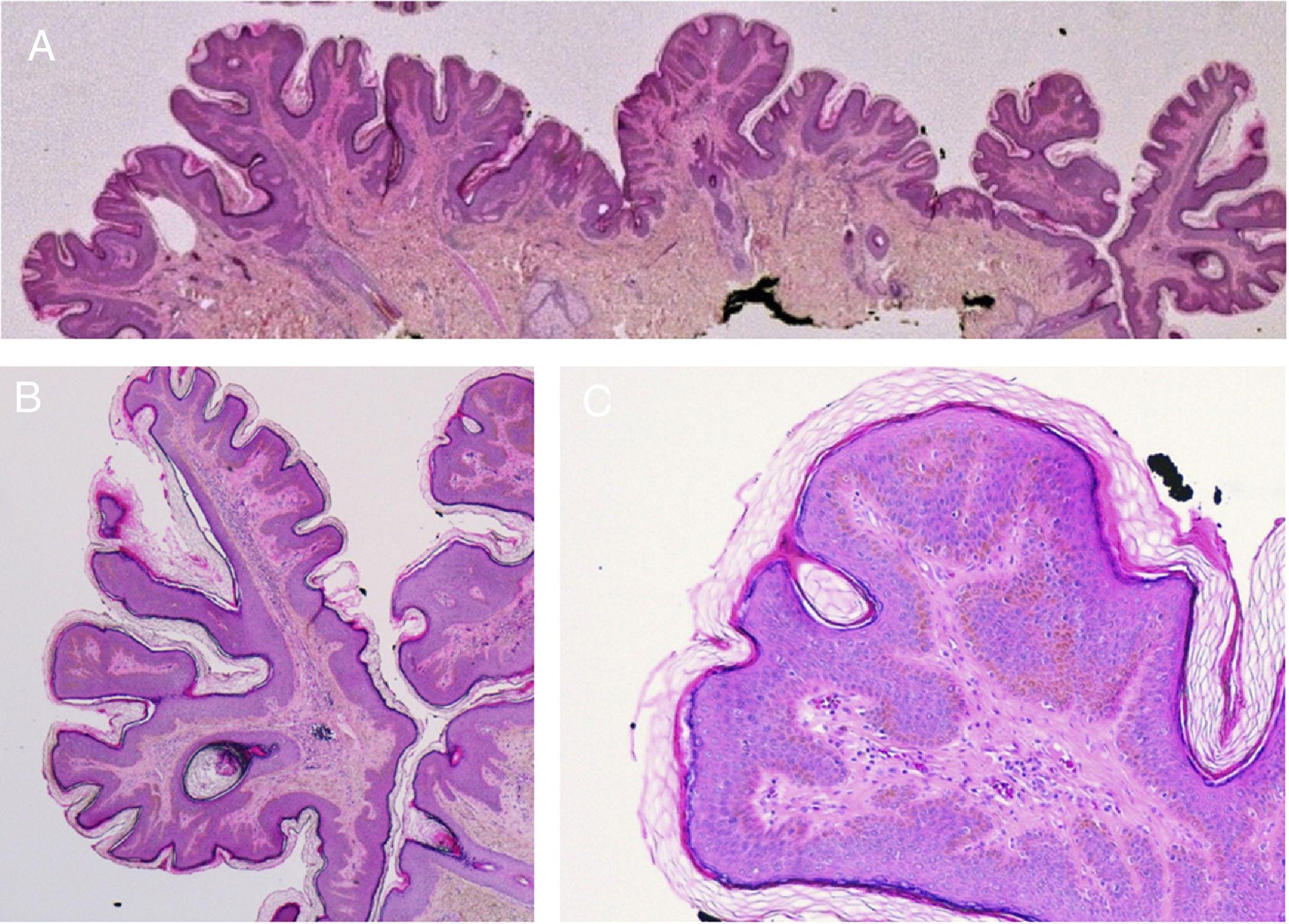 Epidermal Nevi and Related Syndromes — Part 1: Keratinocytic Nevi ...