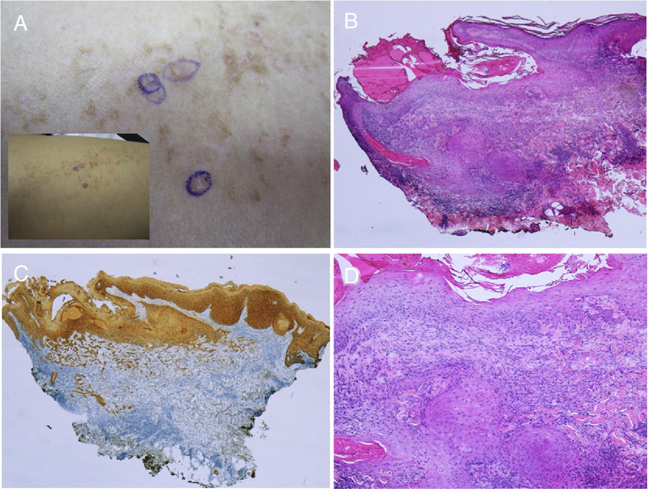 Nevus Comedonicus Histology