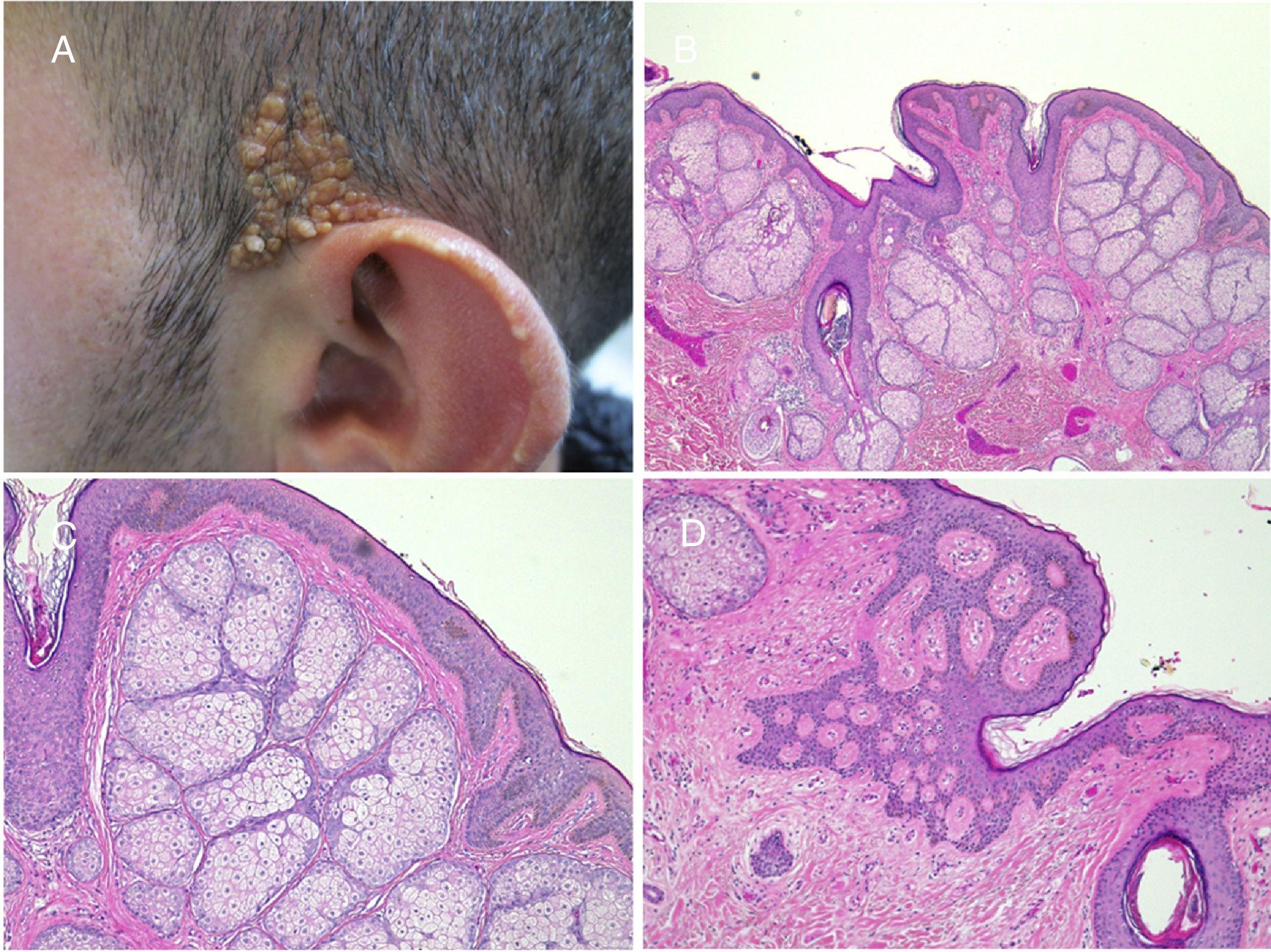 Epidermal Nevus Histology