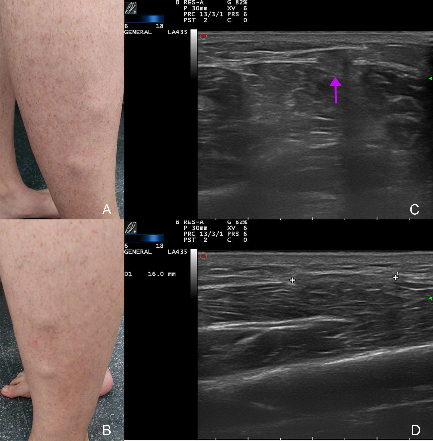 The Utility of Ultrasound in the Diagnosis of Muscle Hernias in the ...