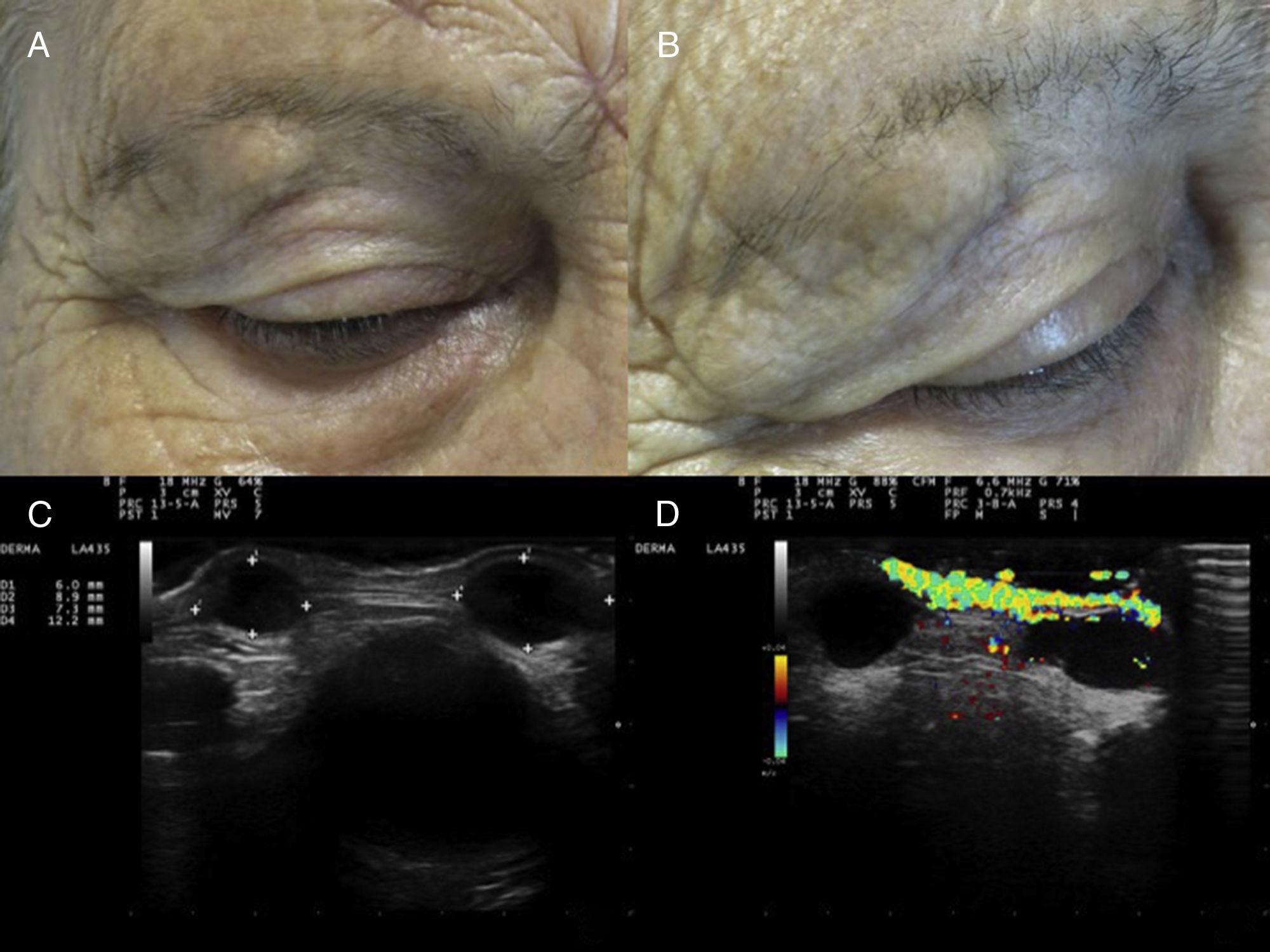 Ultrasound Assessment of a Subcutaneous Eumycetoma of the Eyebrow in an ...
