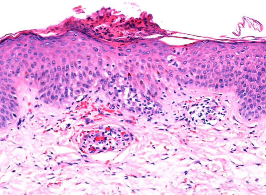 Porokeratosis-Like Grover Disease: More Than an Acantholytic Pattern ...