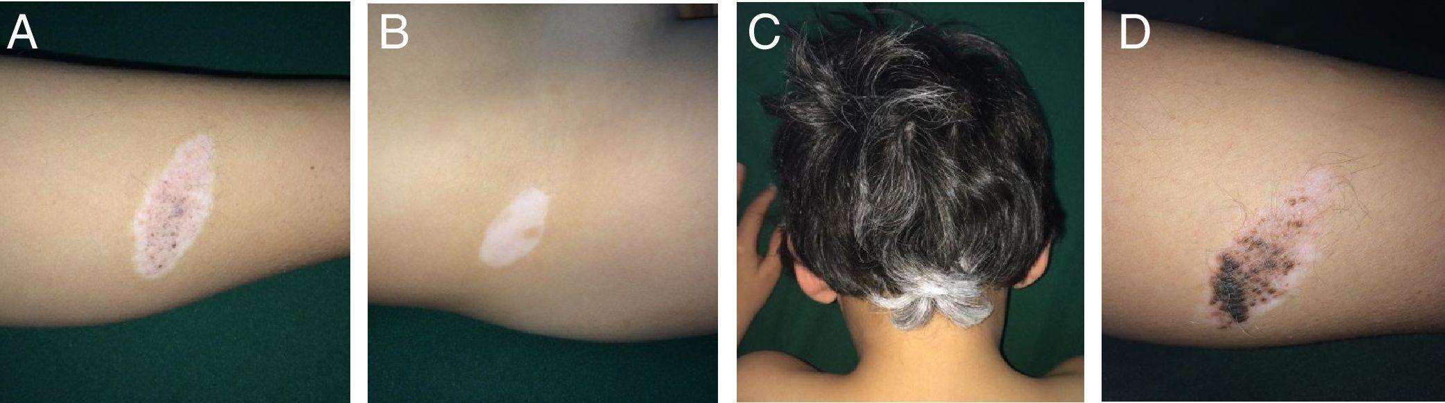 Congenital Nevus Removal Before And After