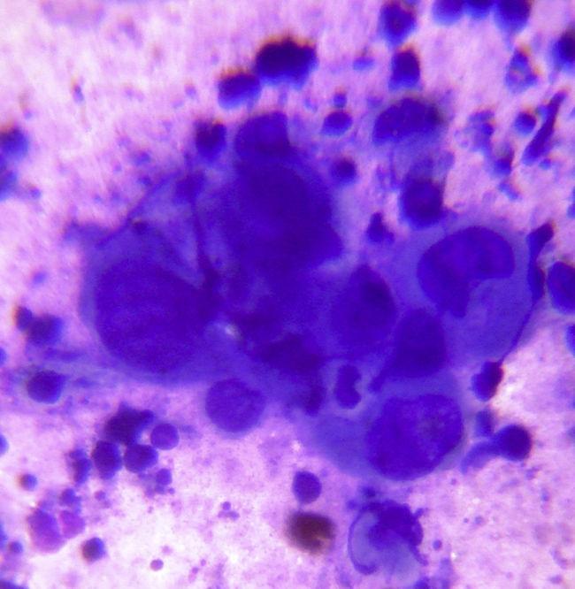 Recurrent Perimenstrual Vesicles Inside the Ear: A Rare Presentation ...