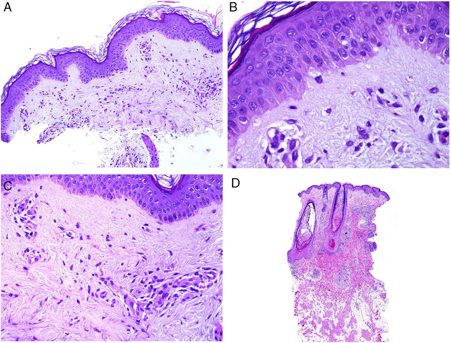 Skin Biopsy in the Context of Systemic Disease | Actas Dermo ...