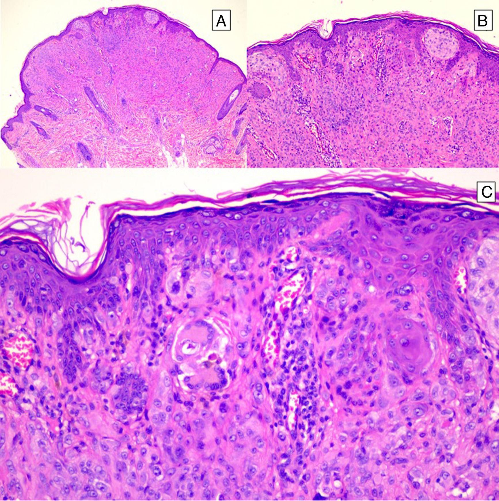 Spitz Nevus and Other Spitzoid Tumors in Children —Part 1: Clinical ...