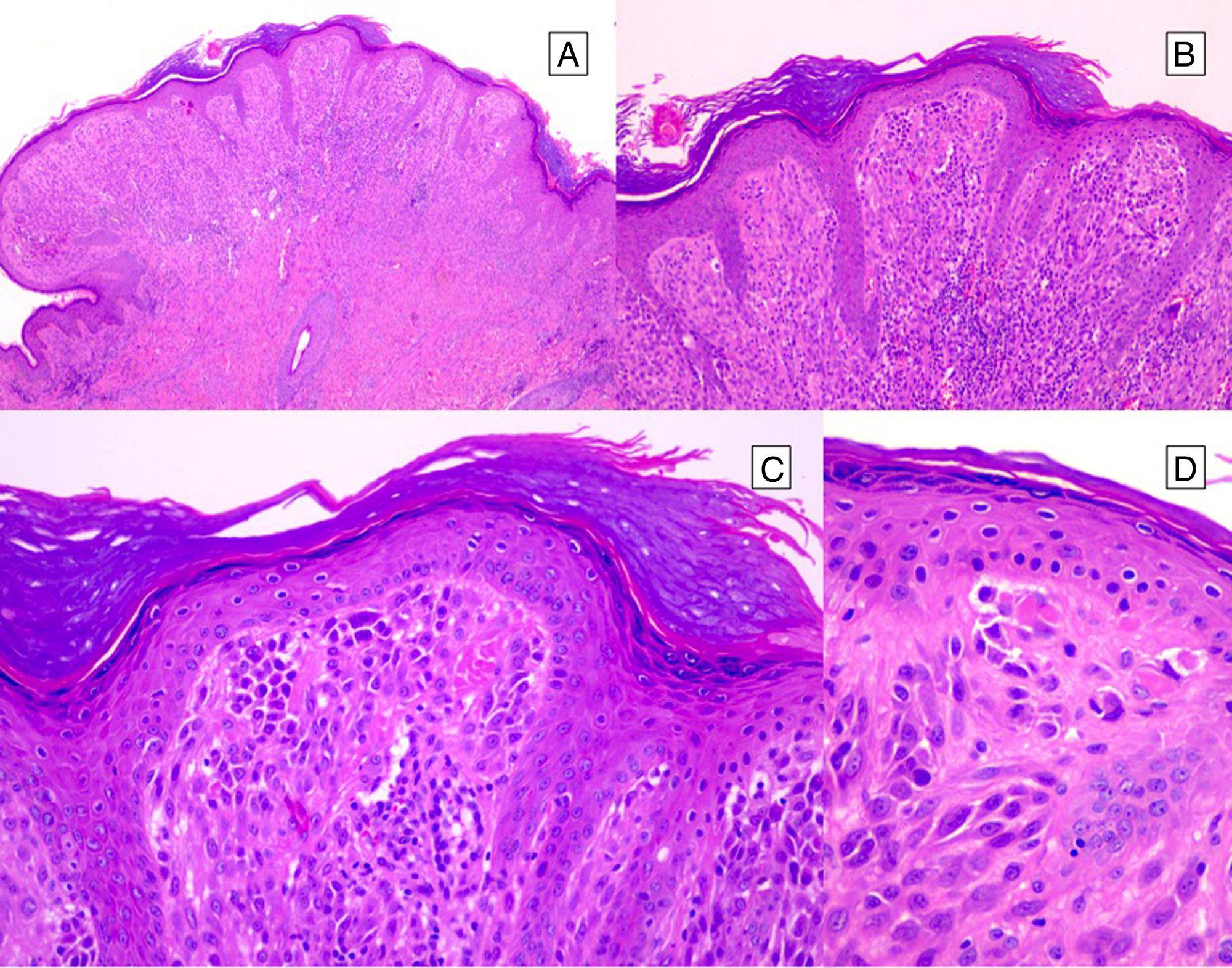 Spitz Nevus and Other Spitzoid Tumors in Children —Part 1: Clinical ...