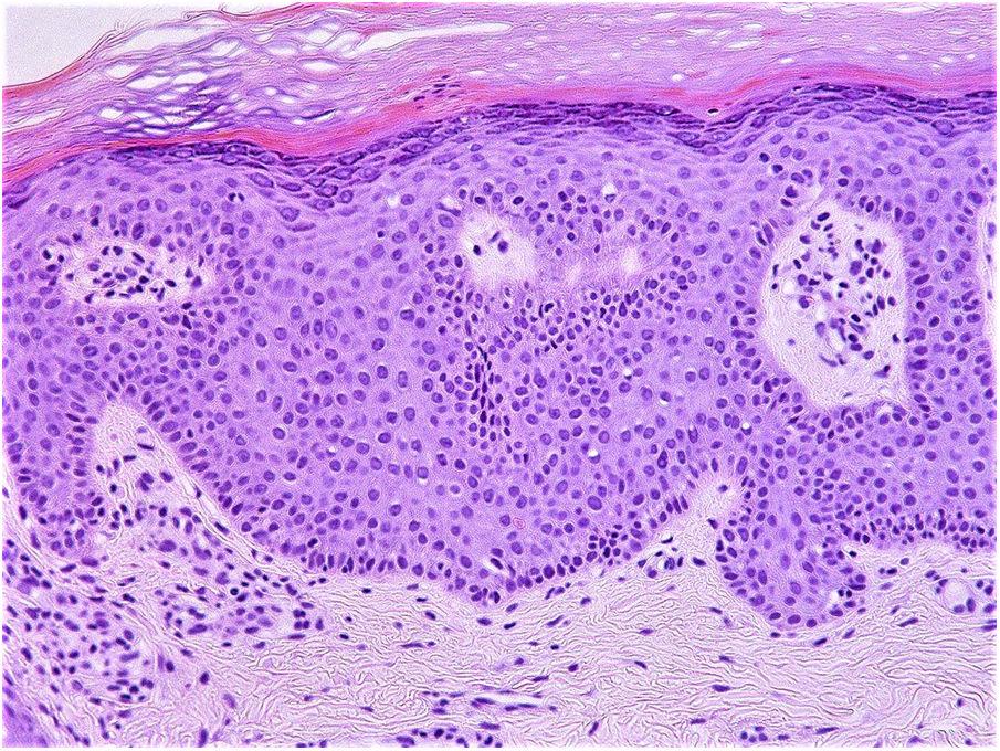Papular Epidermal Nevus With “Skyline” Basal Cell Layer: A Report of 3 ...