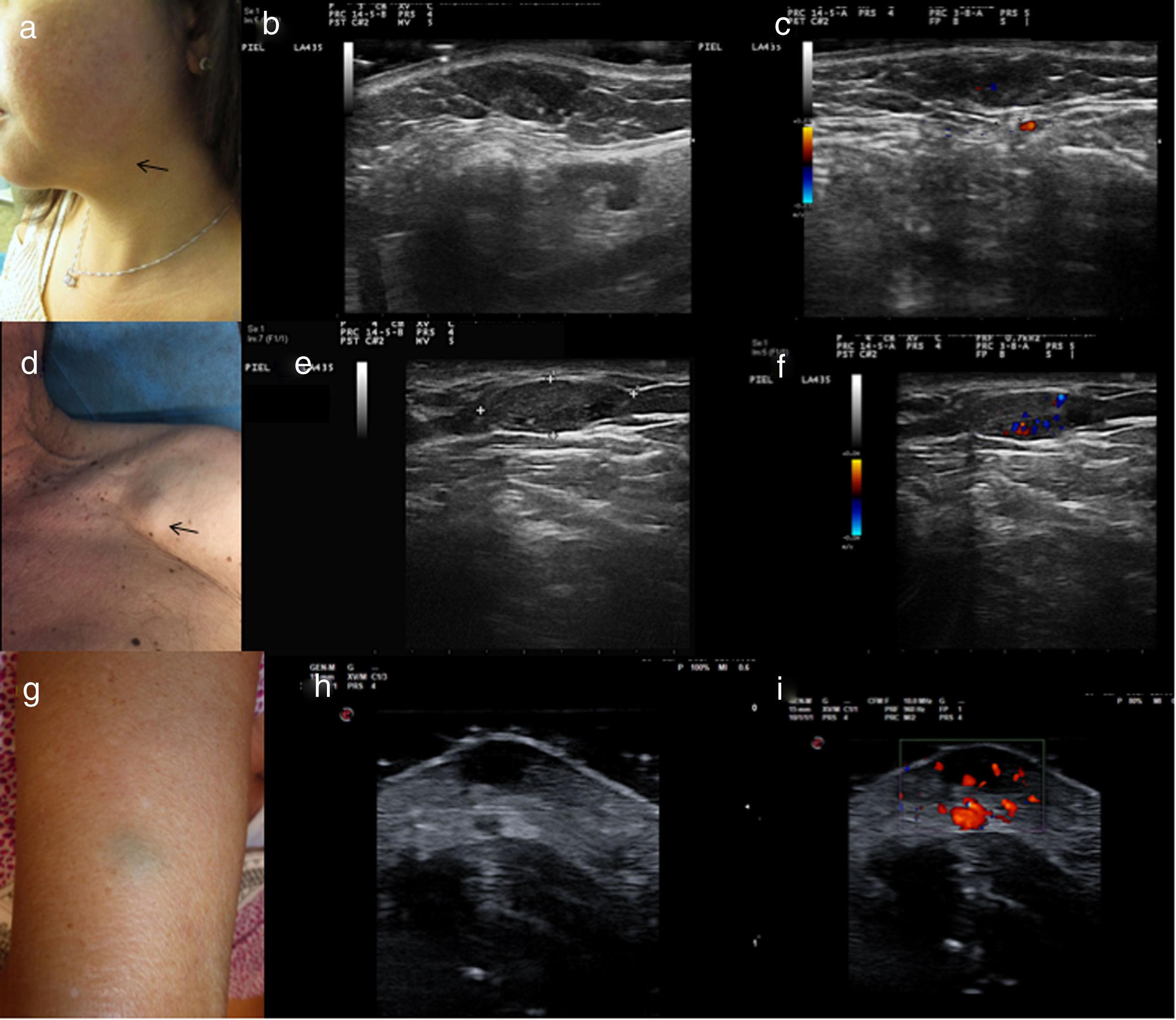 Sinusoidal hemangioma: Correlation Between Ultrasound and Histologic ...